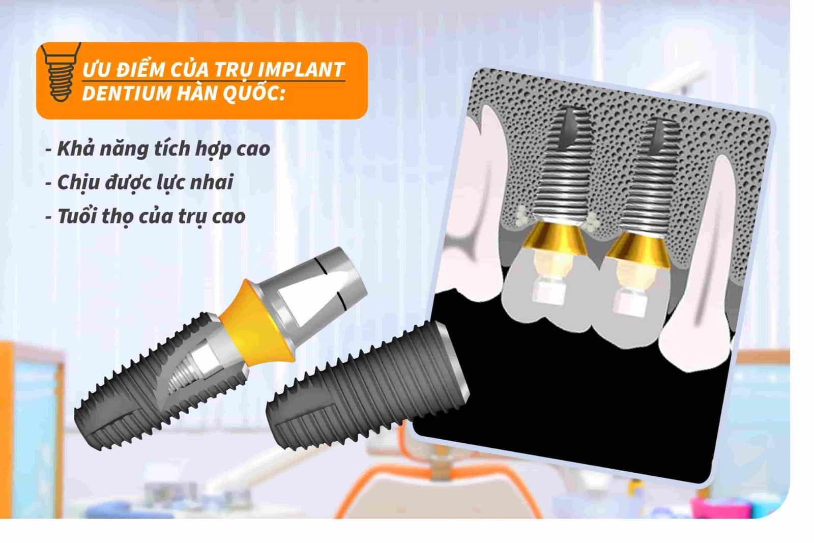 Trụ Implant Dentium (Hàn Quốc) - Xuất xứ, ưu điểm và giá | Up Dental